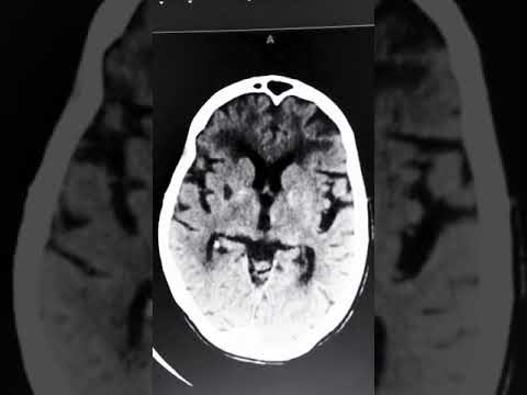 CT SCAN of the head with BRAIN ATROPHY