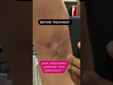 Dark underarms killing your confidence | Dr Ashima Goel| Dermatologist |Chandigarh|Mohali #shorts