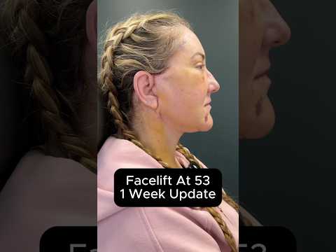 Facelift At 53 - 1 Week Update (Interview)