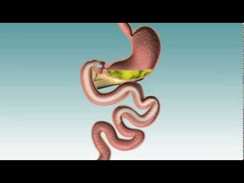 See How The EndoBarrier Works