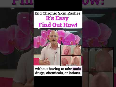 Lupus Rash? Can Your Be Clear Again?