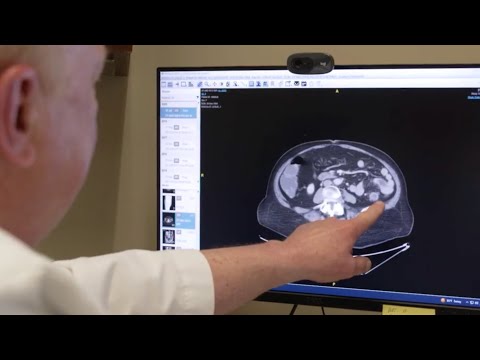 Diverticulitis: The left side appendicitis