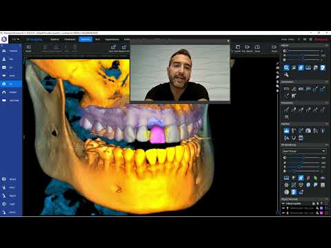 Detailed tutorial on the direct to fixture printed presurgical provisional.