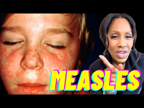 WHAT IS MEASLES? MEASLES Symptoms, Treatments & Vaccine! 😱Do You Need a Measles Booster?