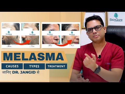 All About Melasma | Causes, Types and Treatment options | जानिए Dr. Jangid से (हिंदी में) | SkinQure
