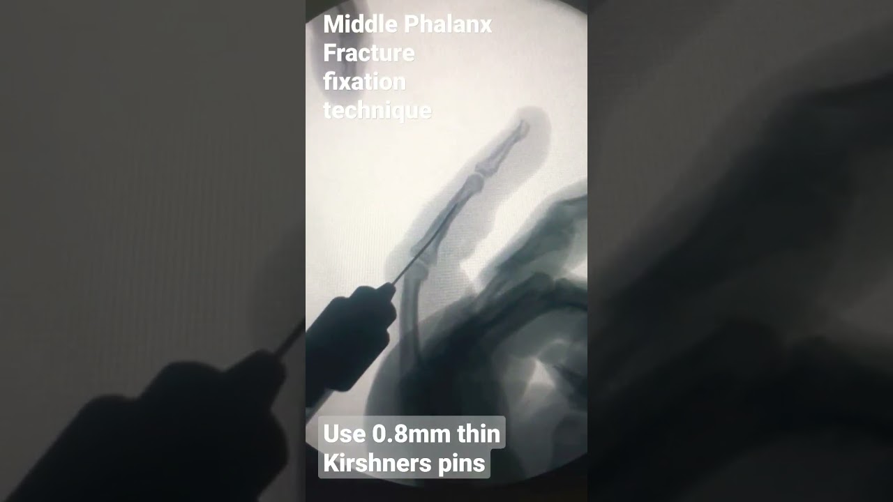 Technique for fixation of Middle phalanx shaft fracture
