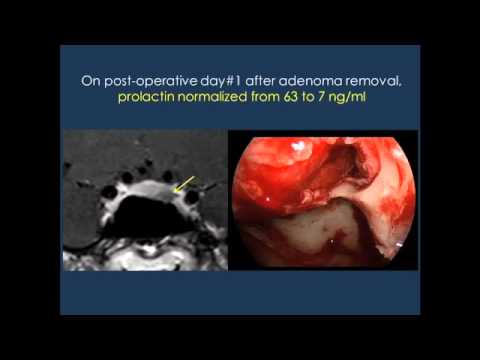 Updated Video Available: Endoscopic Endonasal Prolactinoma Surgery