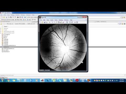Sparse Dissimilarity-Constrained Coding for Glaucoma Scre|Best MATLAB Project institute in bangalore