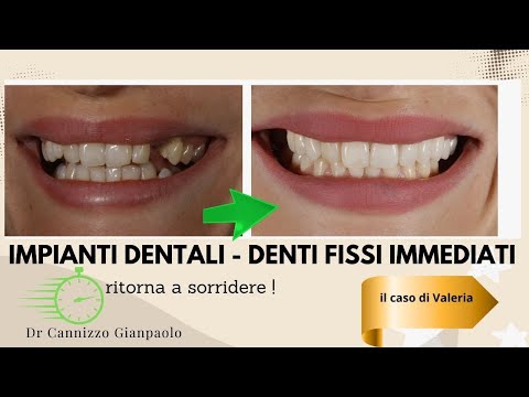Impianto dentale su un singolo dente - Studio Cannizzo Milano