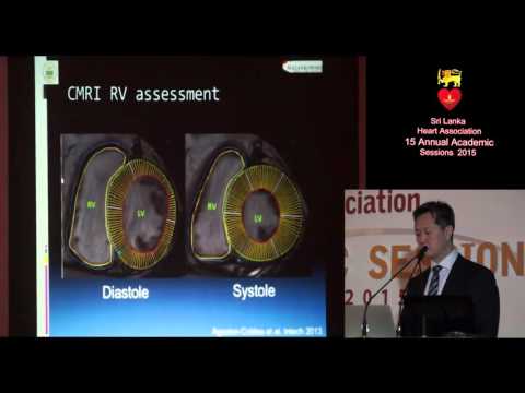 Update on Right Ventricular Failure