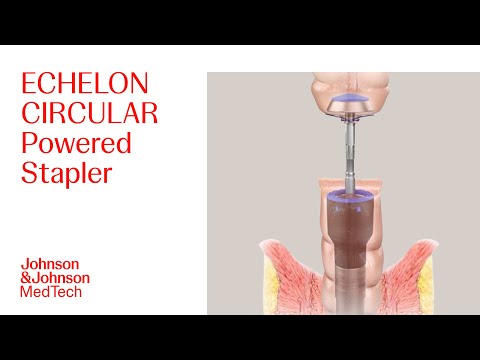 How to Use ECHELON CIRCULAR Powered Stapler | J&J MedTech