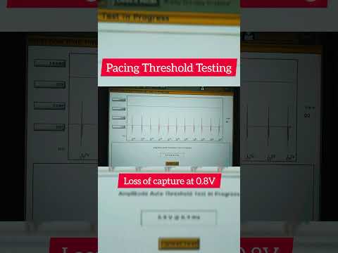 Pacemaker Threshold Testing - Capture Management #bostonscientific #ppm #pacemaker #heartbeat