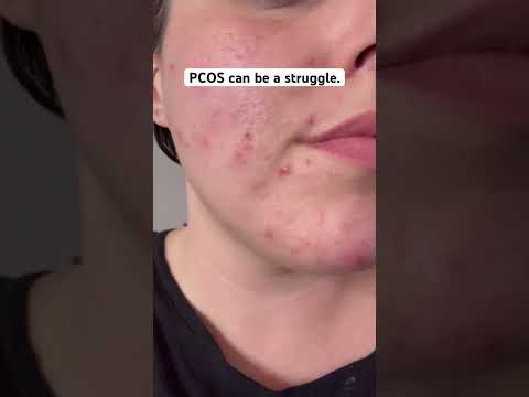 PCOS isnât your identity. Remember that you are beautiful and capable. #pcos #pcoscommunity