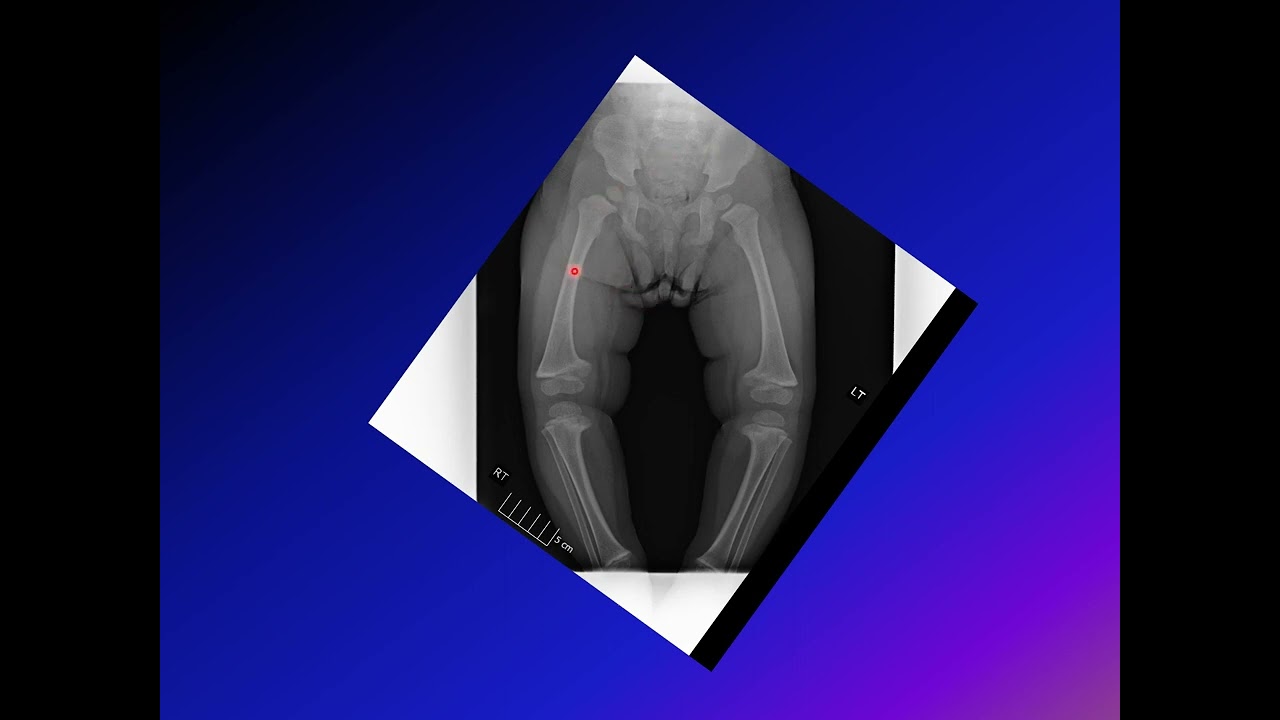 Understanding Blount's Disease: Pathology, Diagnosis, and Treatment ...