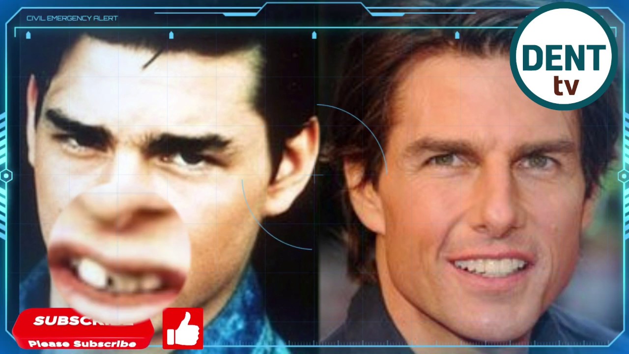 Tom Cruise dental midline shift: teeth surgery and braces to treat middle tooth(before and after)