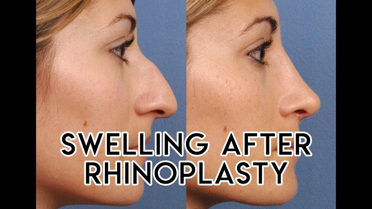 Swelling After Rhinoplasty