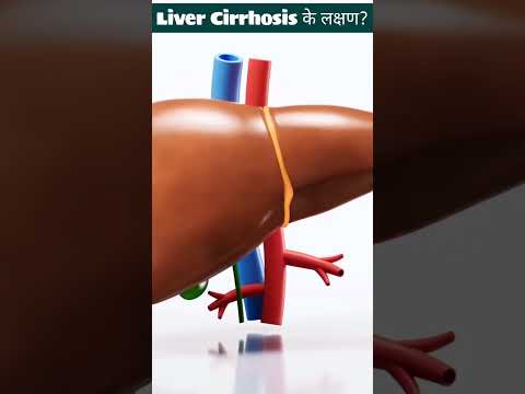 Early Signs of Liver Damage | Know the Symptoms of Liver Cirrhosis | Liver Cirrhosis Symptoms in ...