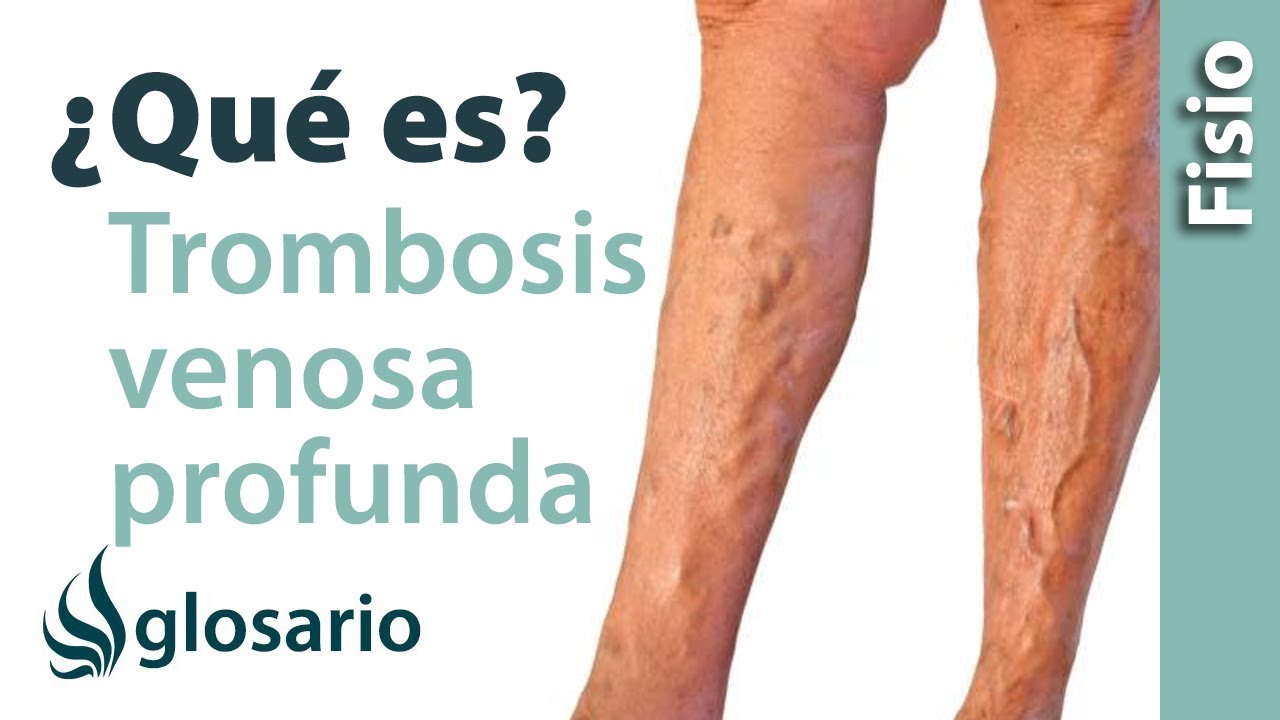 TROMBOSIS VENOSA PROFUNDA | ¿Qué es?