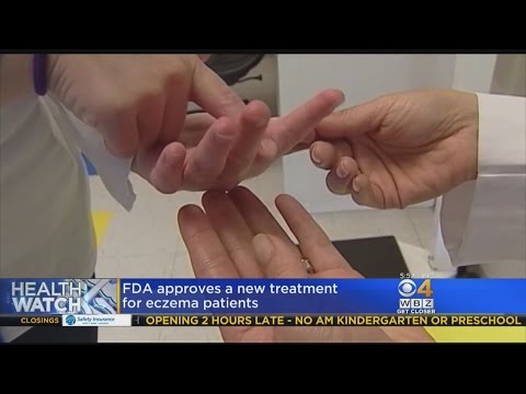 FDA Approves New Treatment For Eczema