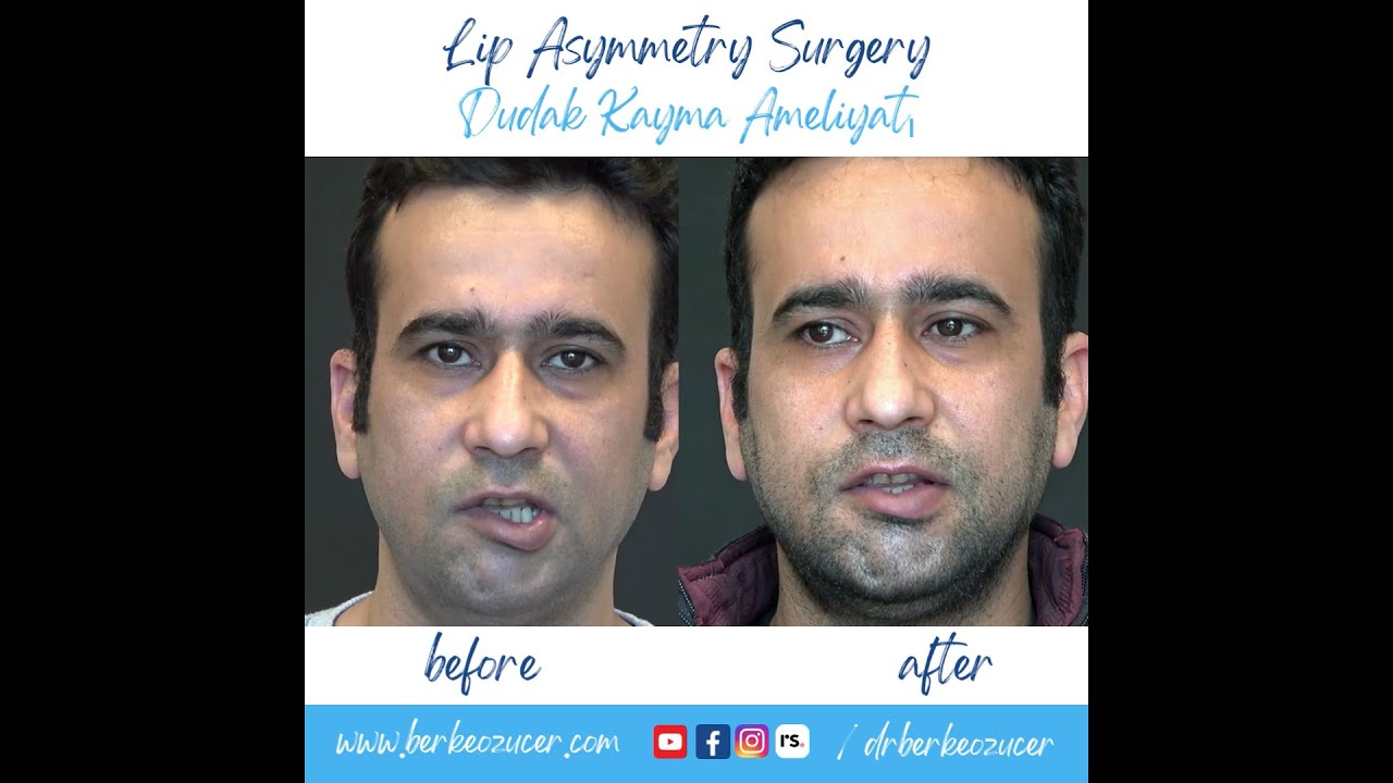Lip Asymmetry Correction Surgery - Asymmetric Crying Facies Treatment