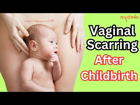 Vaginal Scarring (tearing) After Childbirth!