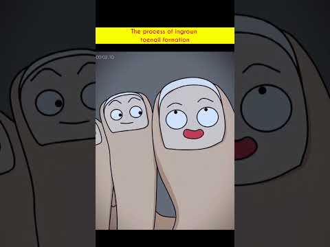 The process of ingrown toenail formation #asmr