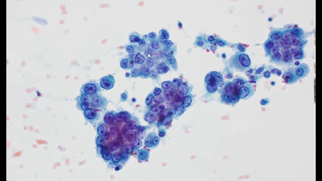 Mesothelioma cytology