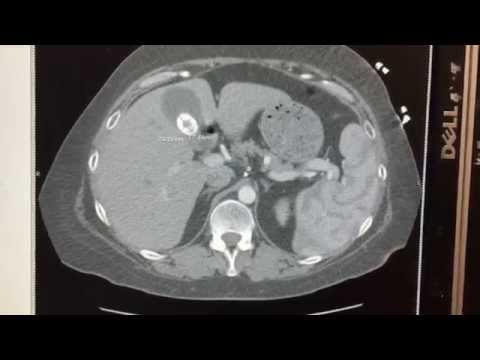Cholelithiasis on CT scan