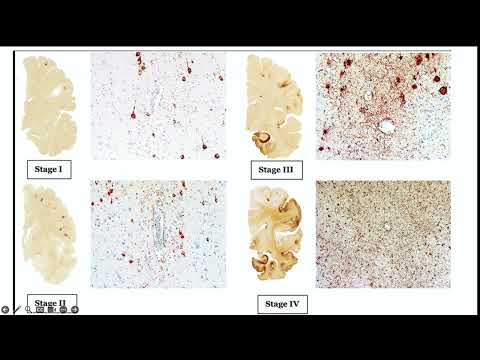 Chronic Traumatic Encephalopathy In The Brains of Military Personnel Journal Club #pathagonia