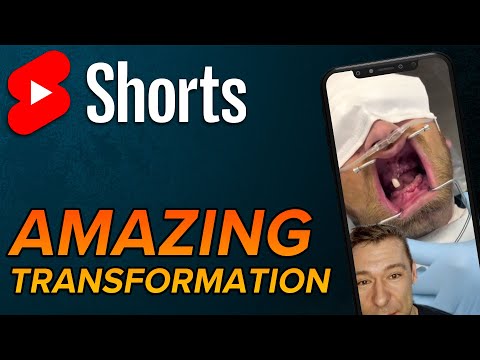 1 Day Transformation - Neue Zähne #shorts