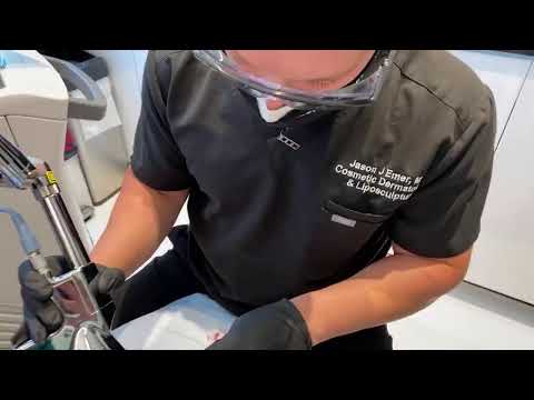 PROFRACTIONAL GOT RID OF MY ACNE SCARS | LASER SKIN RESURFACING | Dr. Jason Emer