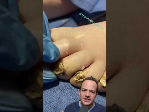 DOCTOR REACTS: ARE THESE TOENAILS DEAD? 😱 #shorts