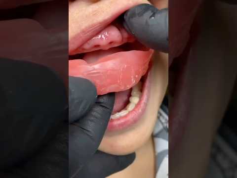 An Extremely Important Method When Creating Dentures #lsk121shorts #dentist #teeth #dentures