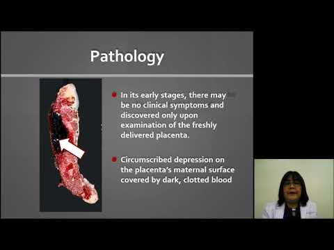 Antepartum Hemorrhage