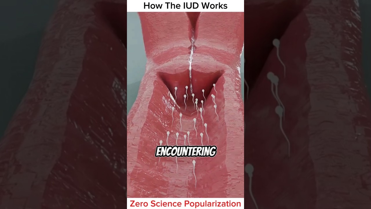 How The IUD Work || #iud