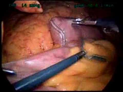 Podcast: Roux-en-Y Gastric Bypass: the gold standard of...