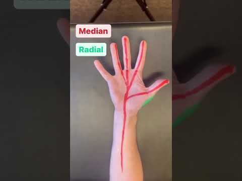 Is Your Radial Nerve Causing Carpal Tunnel Syndrome Symptoms?