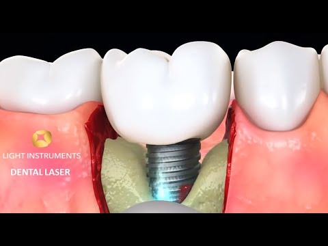 Dental Laser Treatment 2020 - Lite Touch by Dental Laser (Medical Device Animation)