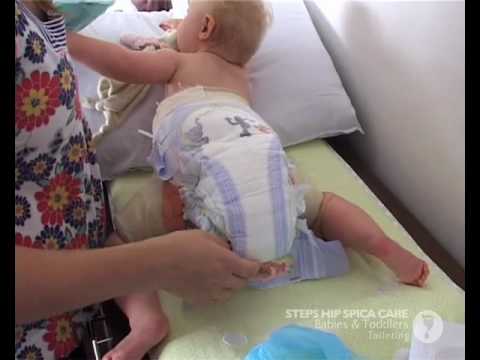 Hip Spica-Baby-Toddler-Toileting.mp4