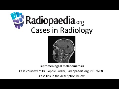 Leptomeningeal melanomatosis (Radiopaedia.org) Cases in Radiology