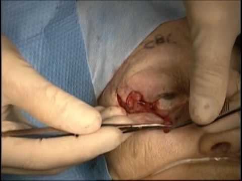 Repair of a lateral canthal defect with an O to Z flap