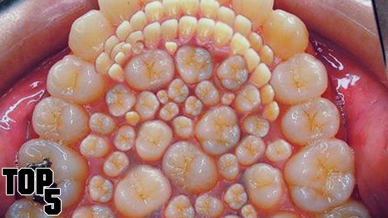 Top 5 Scariest Teeth That Will Haunt You