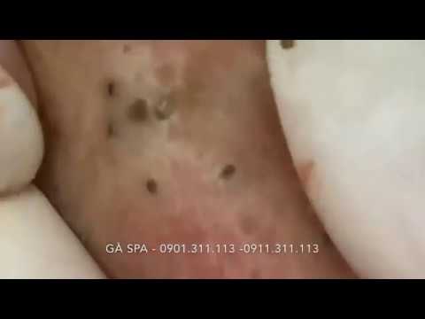 Squeezing BIG Blackheads (SICKENING)