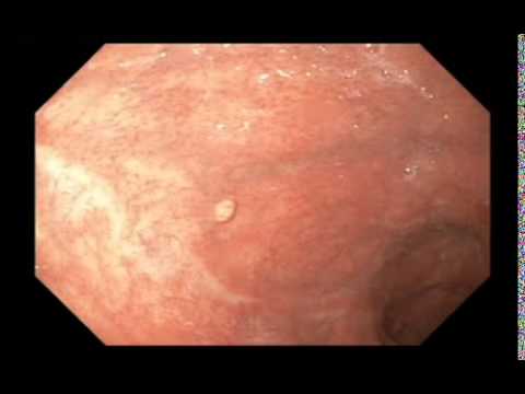 Stomach, Benign Findings, Submucosal Lesion, Pancreatic Rest