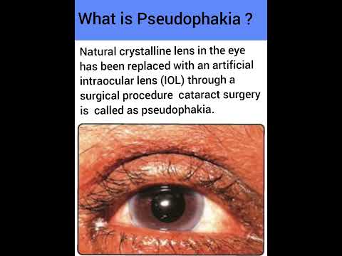 What is Pseudophakia | Optometry Fans