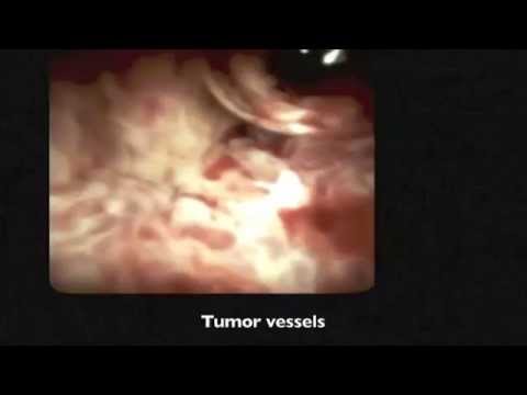 The Center for Interventional Endoscopy at Florida Hospital
