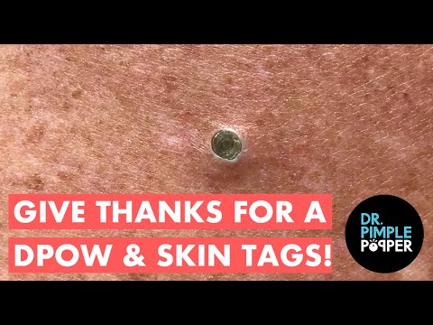 Dr. Pimple Popper Pops 'Volcano' Blackheads For Thanksgiving On Youtube