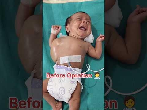 condition After Operation 😊#neonatologist #neonatalcare #newborn #newbornbaby #nicu #surgerysuccess