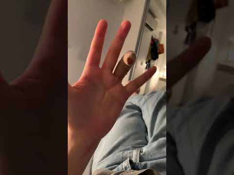 10 weeks post op FDP tendon two stage reconstruction