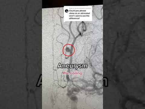 Cerebral Angiogram